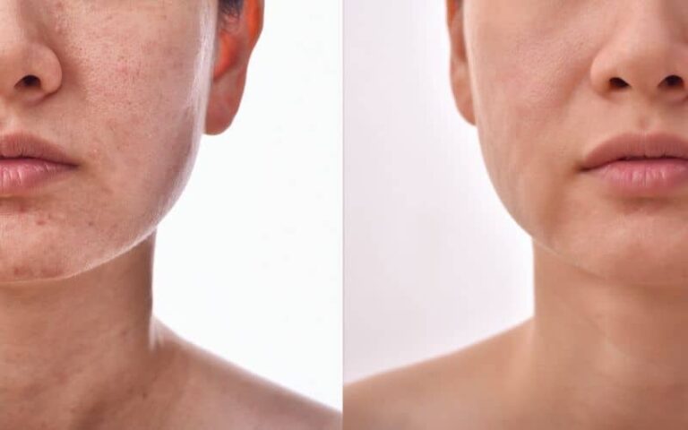 What Causes Sudden Acne Breakout on Face in Adults?